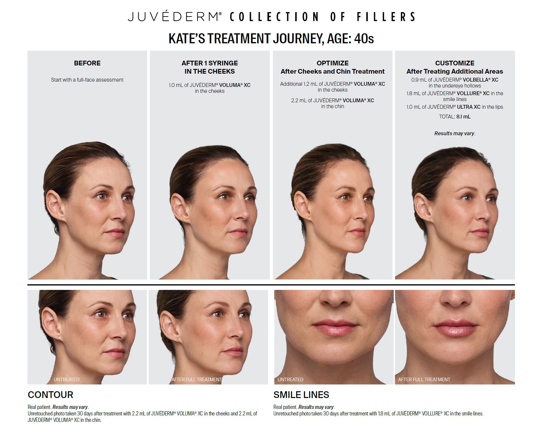 Juvederm Filler Journey | Blue Halo Med Spa